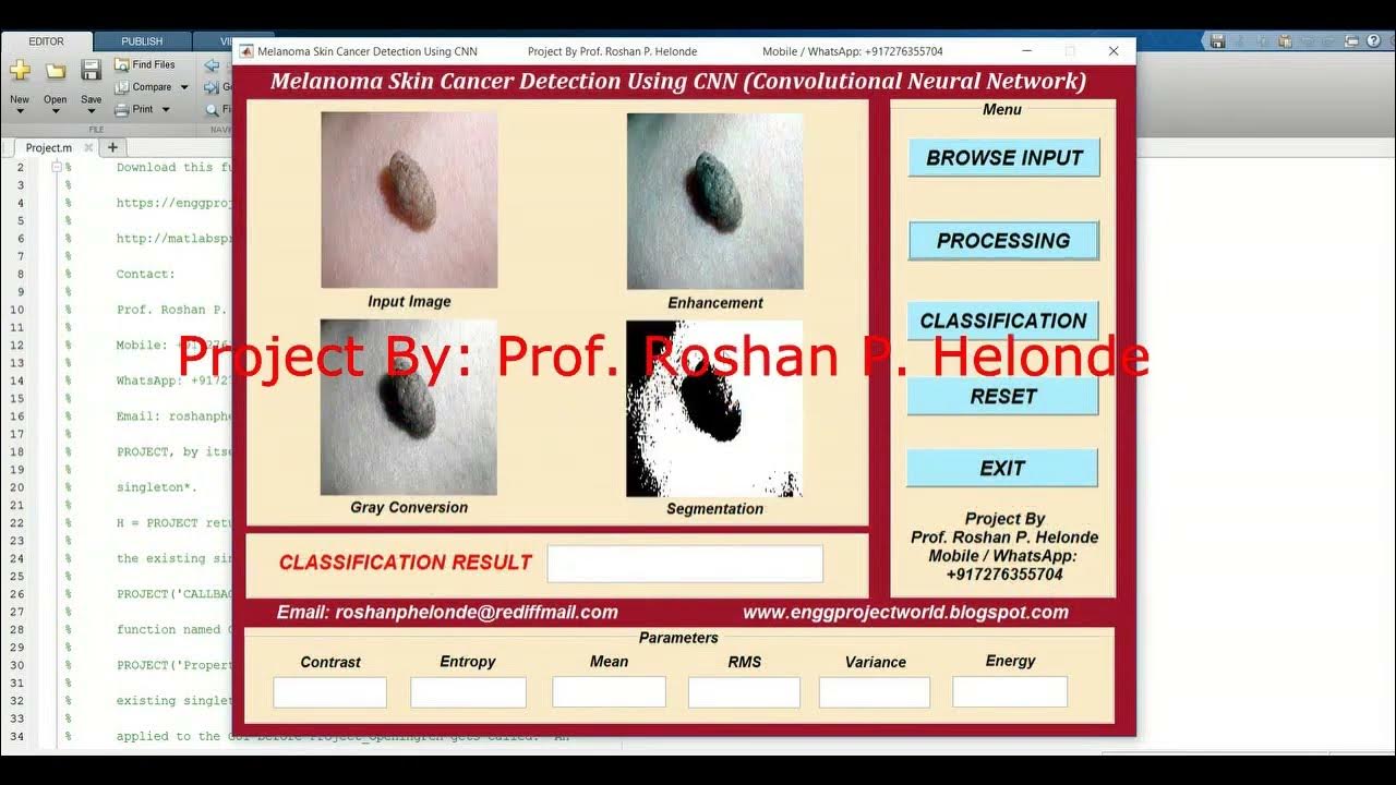 CNN Melanoma Detection Using Matlab Project With Source Code | Melanoma Skin Cancer ...
