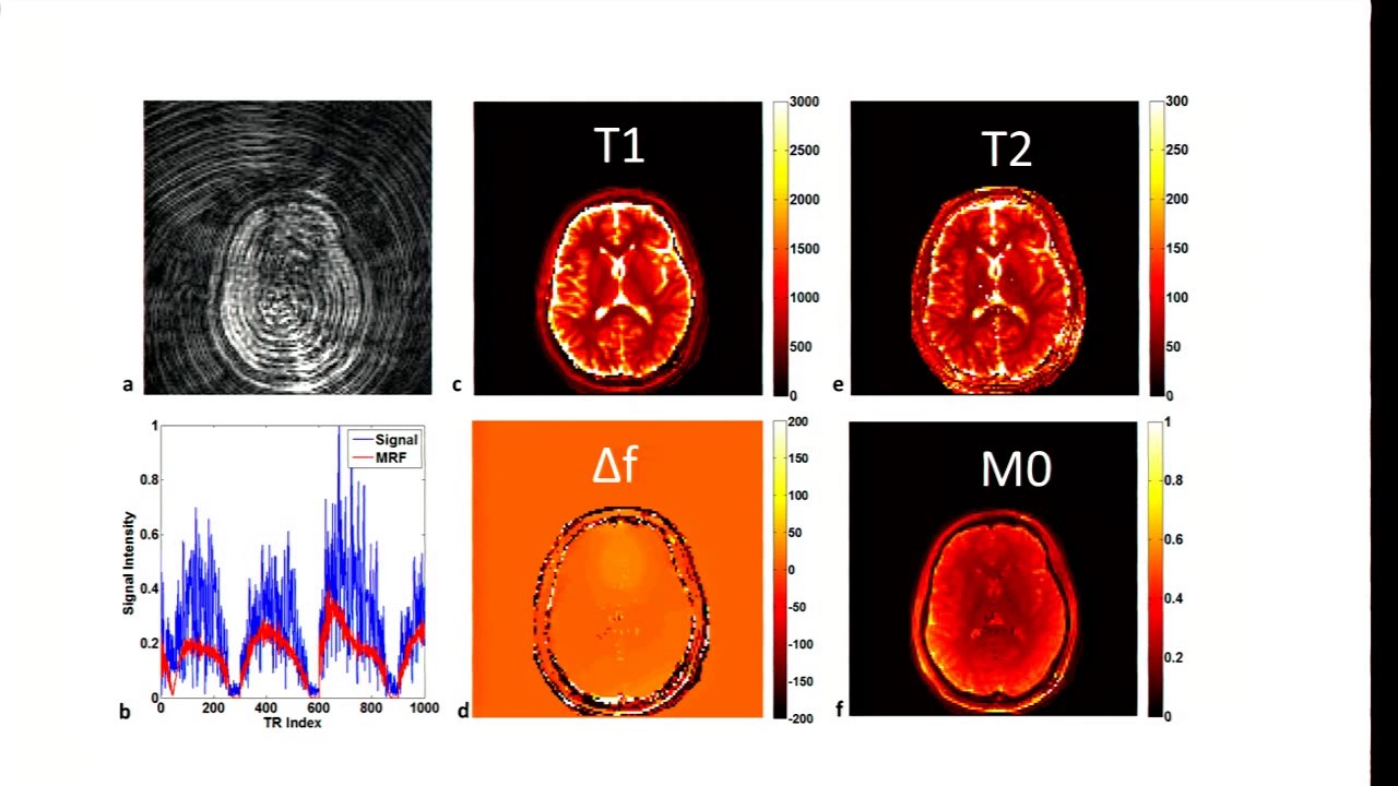 How MR Fingerprinting Could Change the Way We Think About MRI. Mark ...