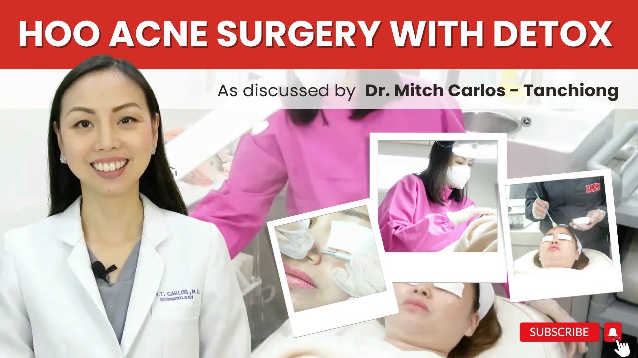 ACNE FACIAL WITH EXTRACTION BY A BOARD-CERTIFIED DERMATOLOGIST - YouTube