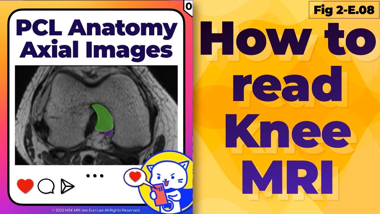 한글 (Fig 2-E.08) Anatomy Of The PCL On Axial Images - YouTube
