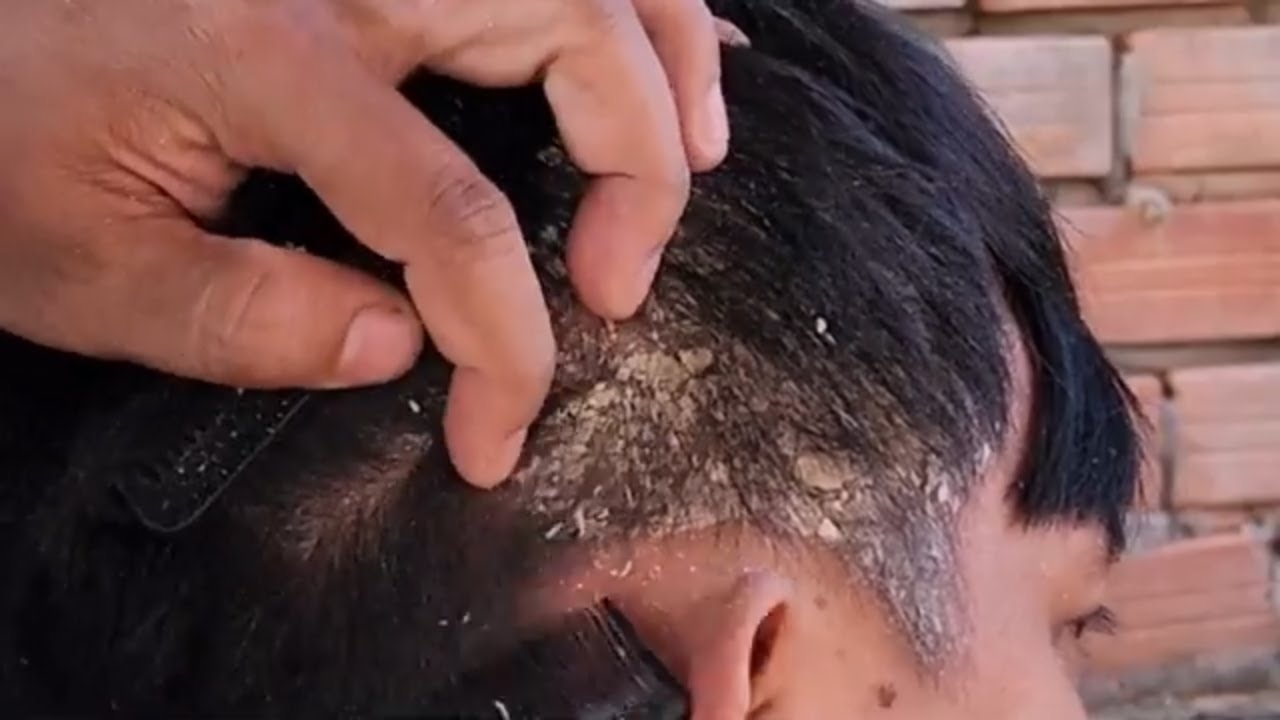 ASMR Scalp Scratching for Sleep and Relaxing Care #497 - YouTube