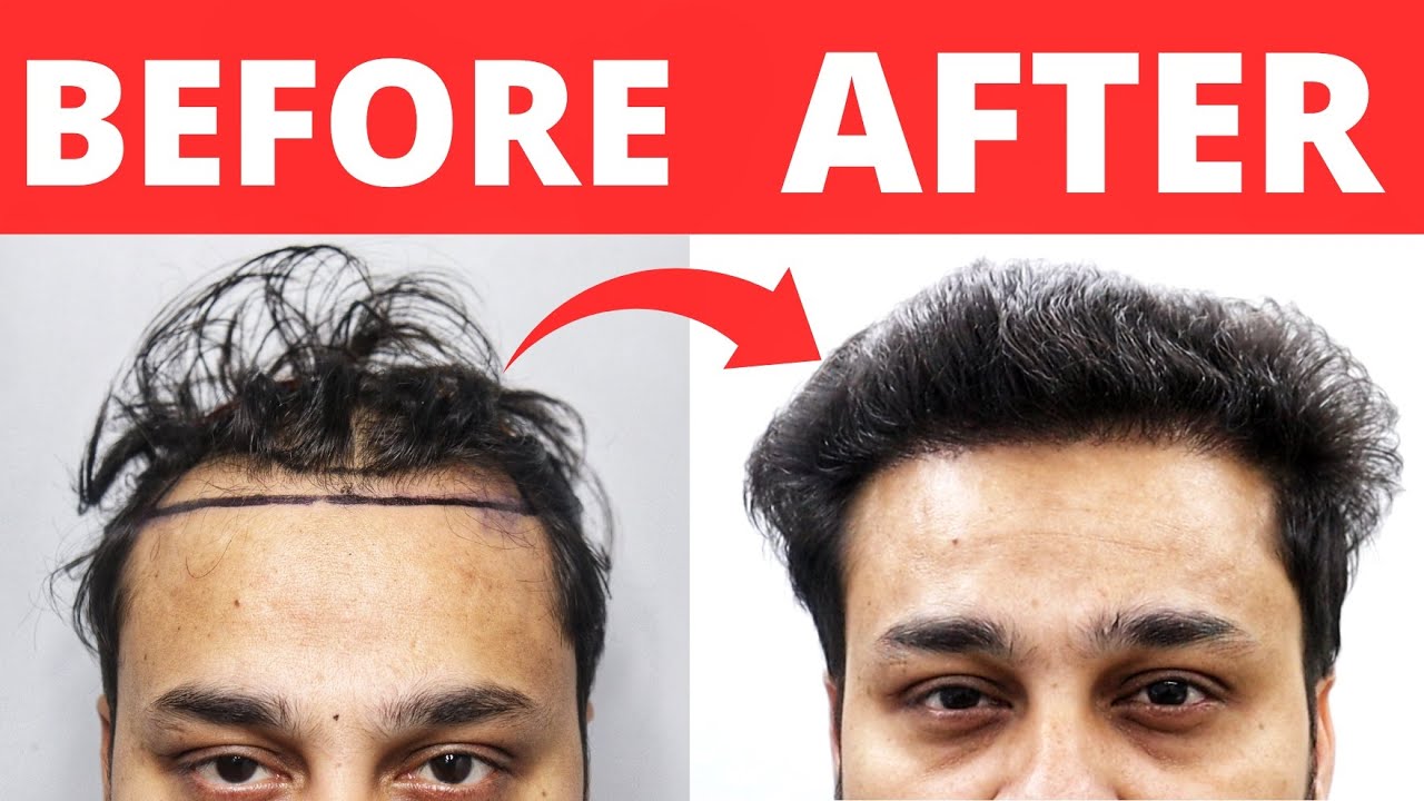 Case Study: Frontal Hair Loss & Crown Thinning Transformation - YouTube