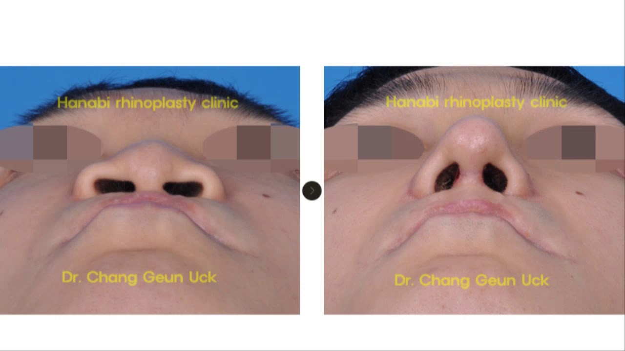 Cleft nose deformity correction by Hanabi - YouTube