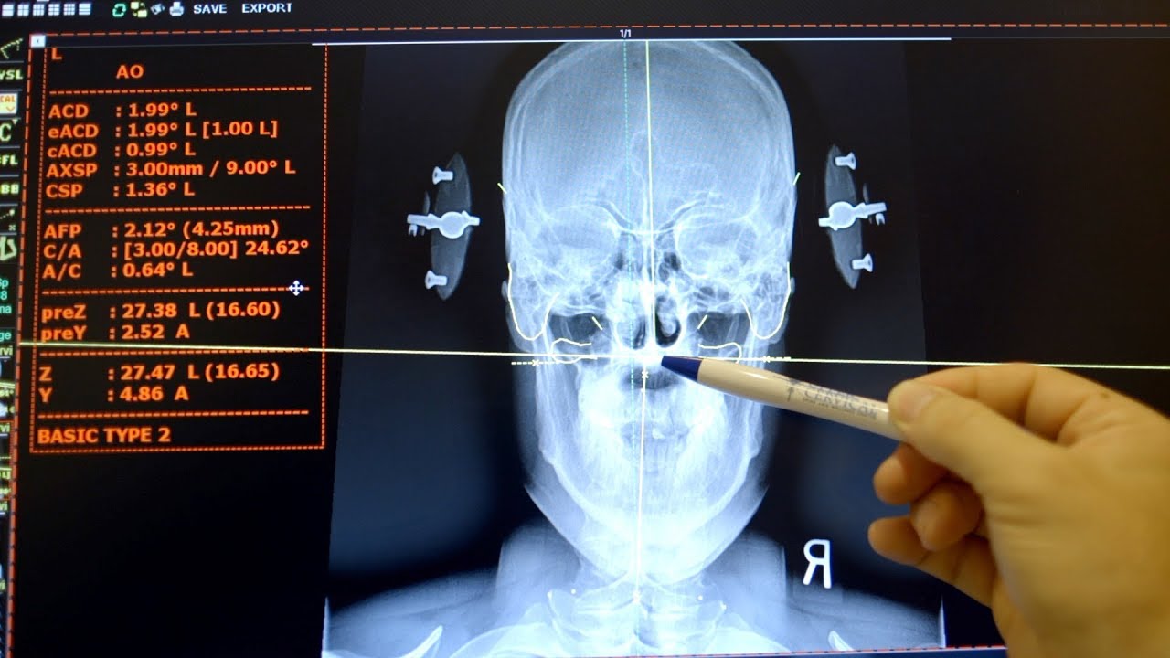 How To Take A Frontal X-Ray | Advanced Orthogonal With Dr. Collins ...