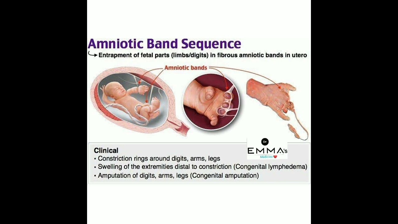 Amniotic Band Syndrome Arm