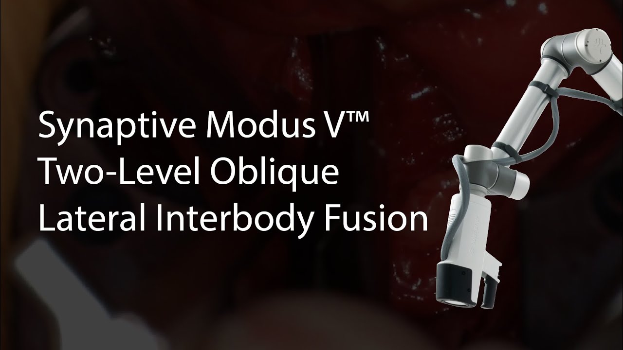 Synaptive Modus V™ - Two-Level Oblique Lateral Interbody Fusion - YouTube