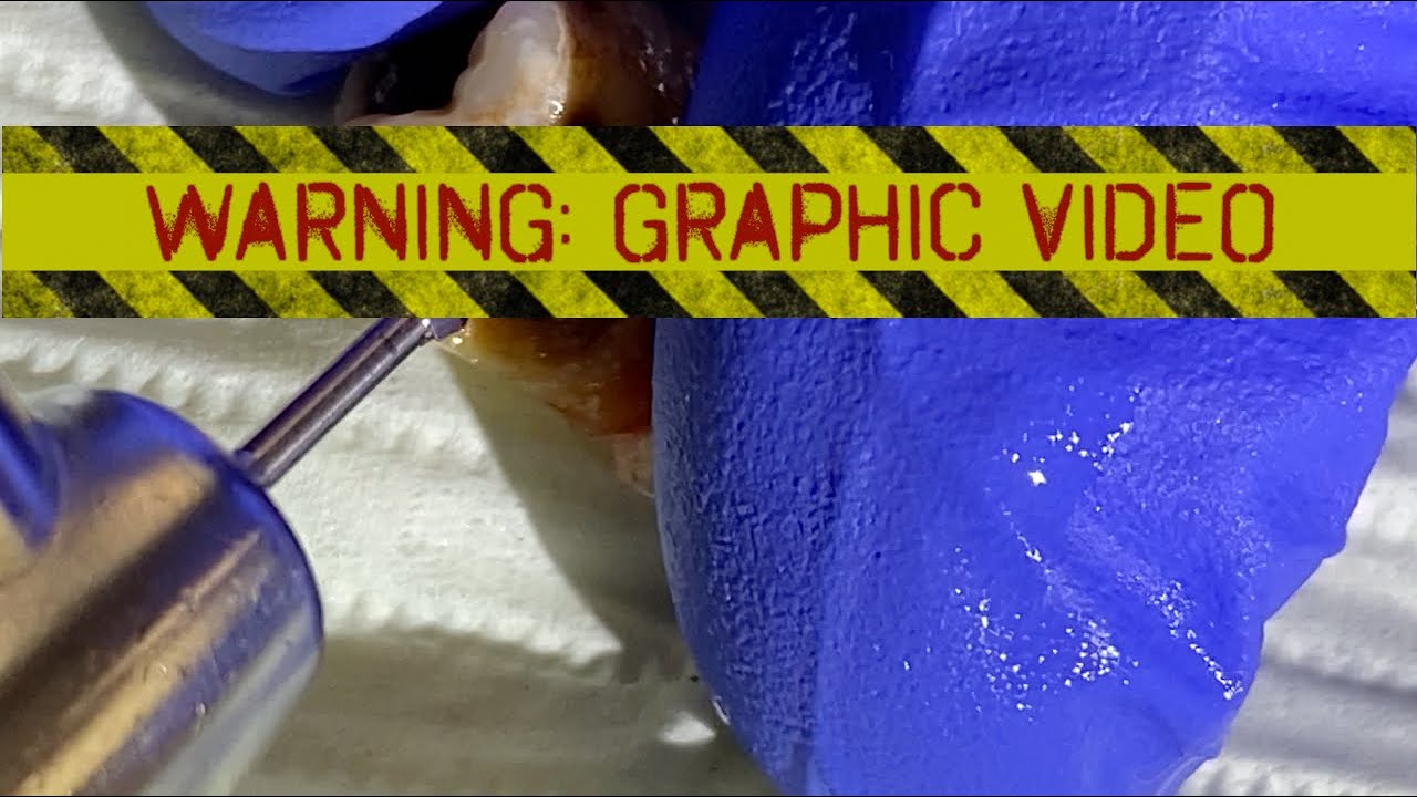 Close Up of the Removal of Gross Decay - A Huge Cavity - YouTube