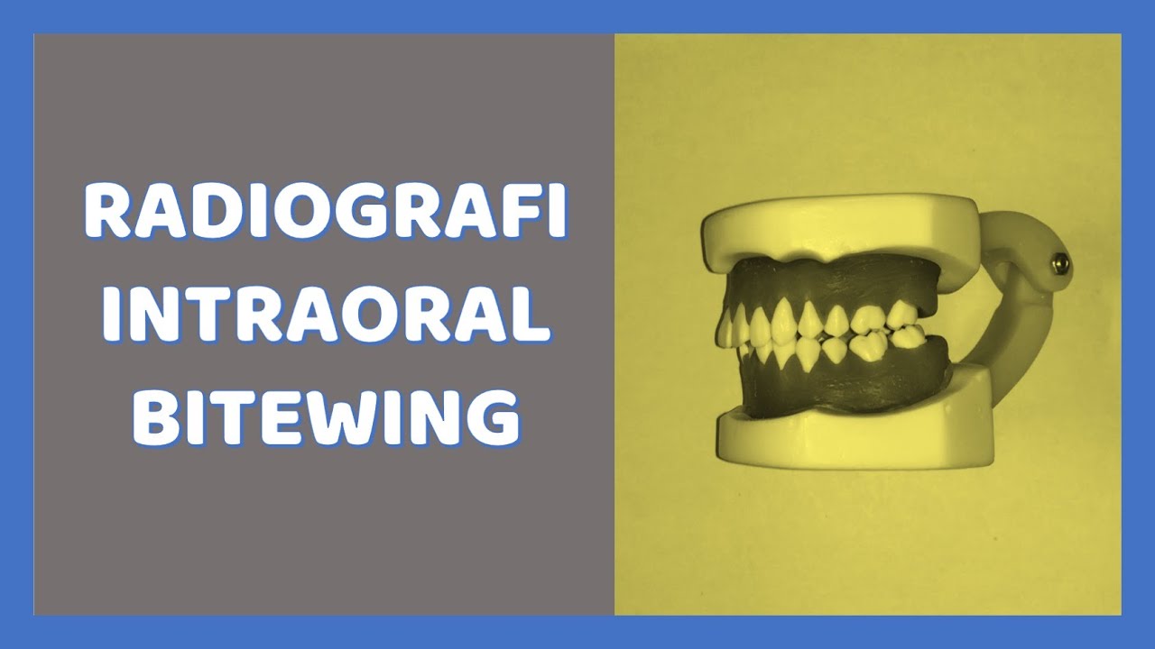 Teknik Radiografi Intraoral Bitewing dengan Holder (Radiologi Dental ...