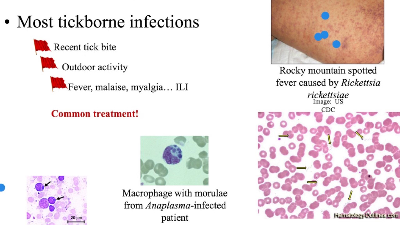 Blood and cardiac infections part 4-bacteremia and sepsis - YouTube