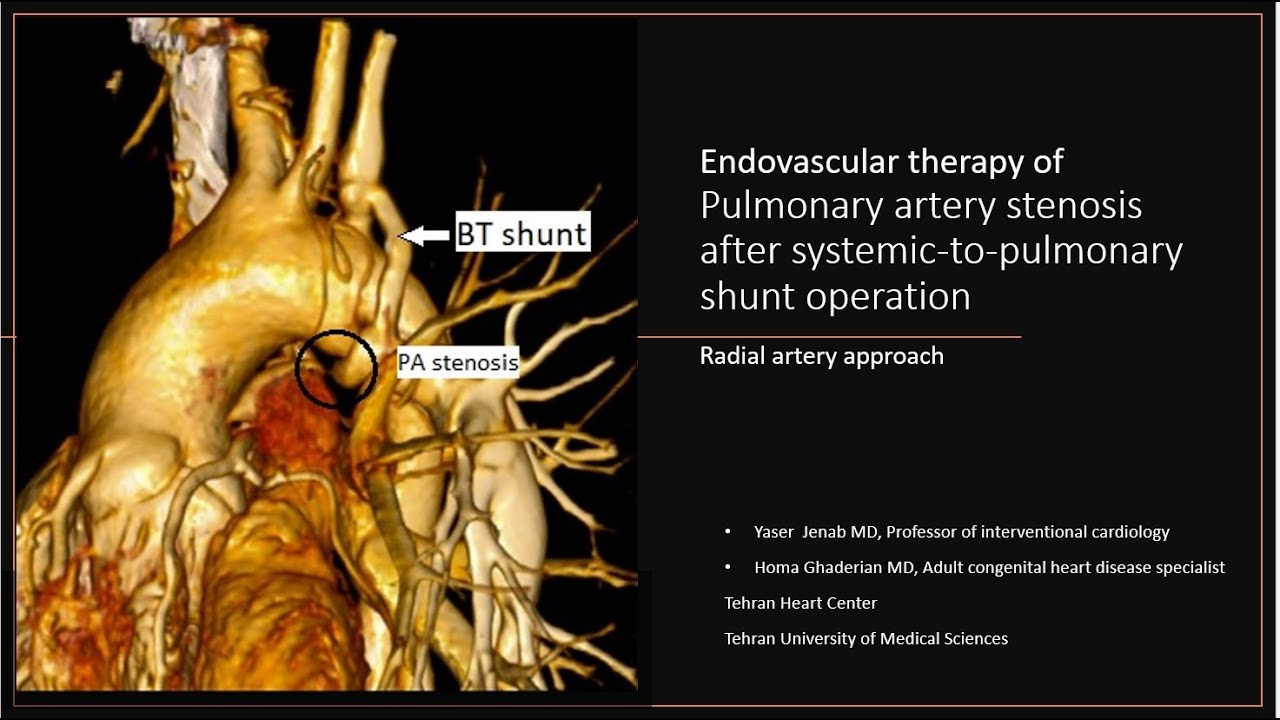 Endovasular approach for pulmonary stenosis after modified BT shunt ...