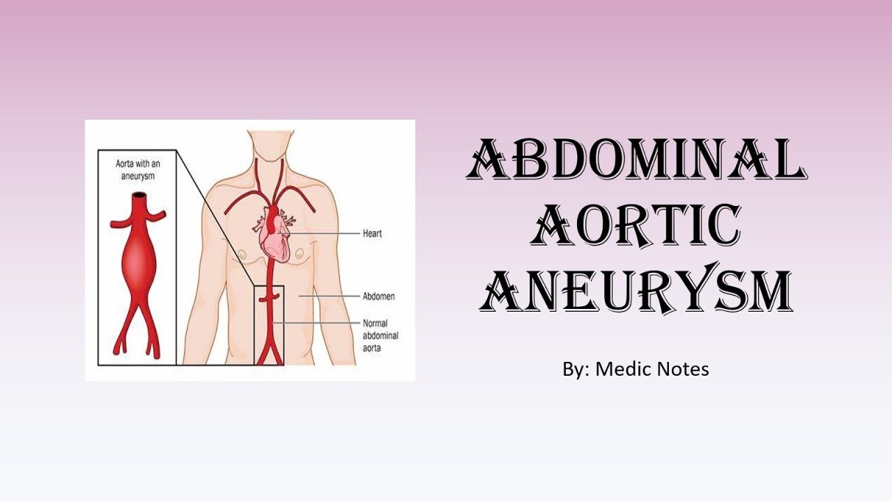 Abdominal Aortic Aneurysm Risk Factors S s Investigation Surgery Abdominal Aortic Aneurysm Risk Factors S s Investigation Surgery