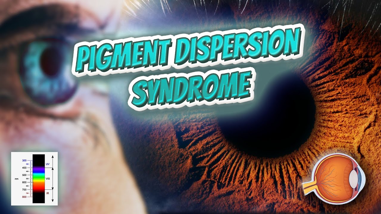 Pigment dispersion syndrome - Your EYEBALLS - EYNTK 👁️👁️💉😳💊🔊💯 - YouTube