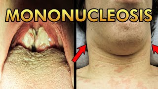 Infectious Mononucleosis Causes Signs And Symptoms Diagnosis And ...