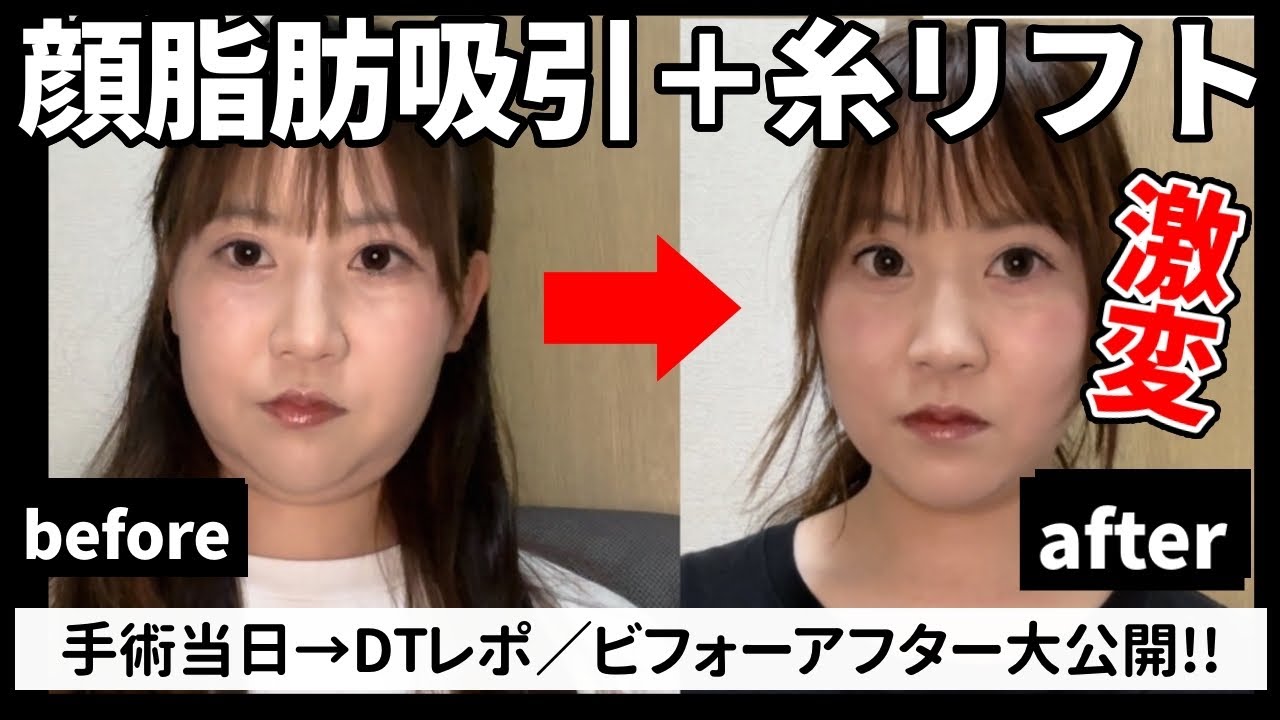 【脂肪吸引レポ】頬•顎下脂肪吸引&糸リフトのダウンタイムの様子。二重顎サヨウナラ【湘南美容クリニック】ジョールファット除去 Youtube