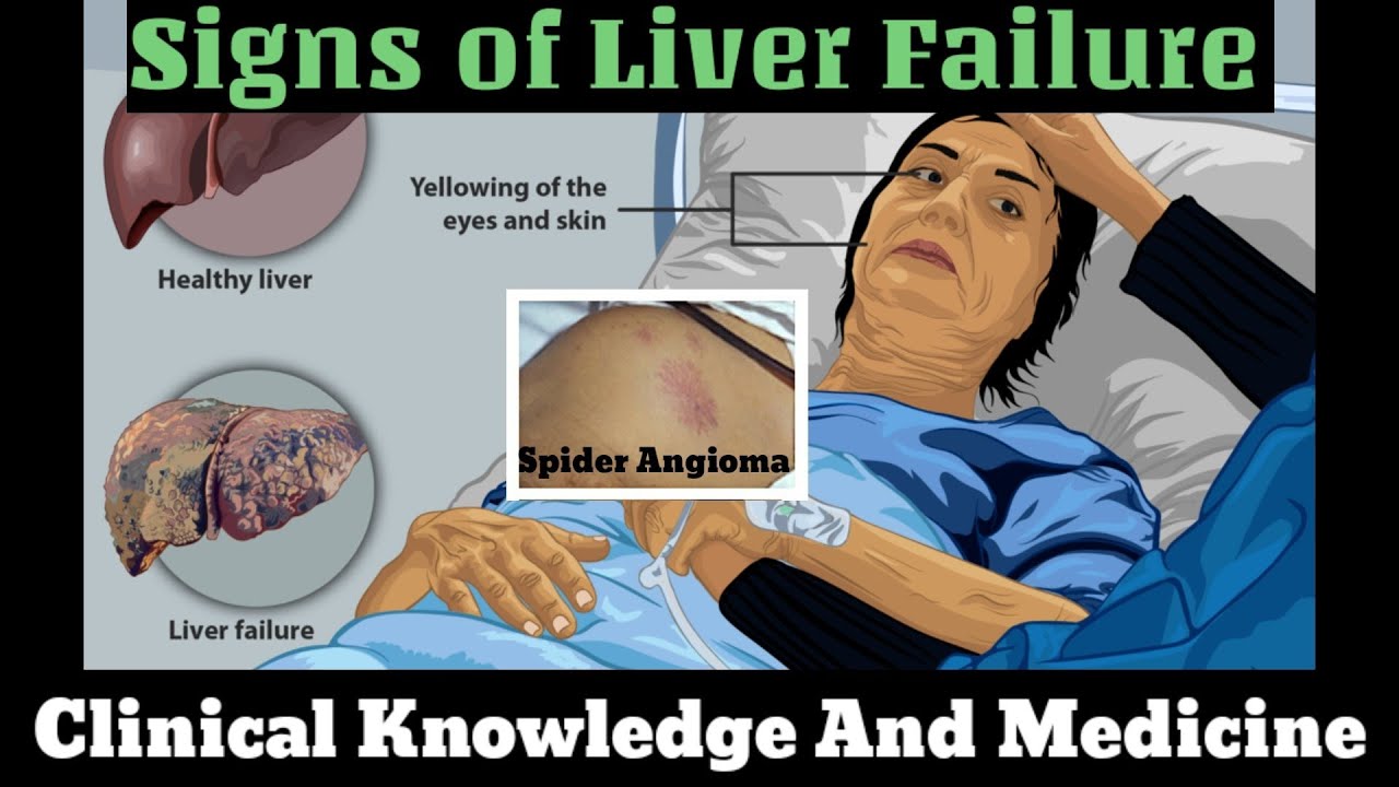CLD Signs - Spider Angioma/ Naevi, Caput Medusae, Leukonychia, Skin ...