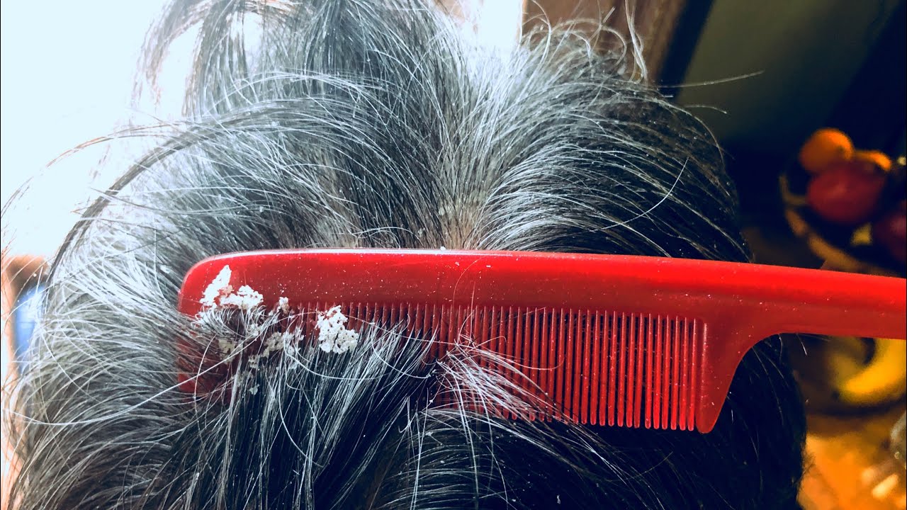 Dandruff build up | Scraping with comb - YouTube