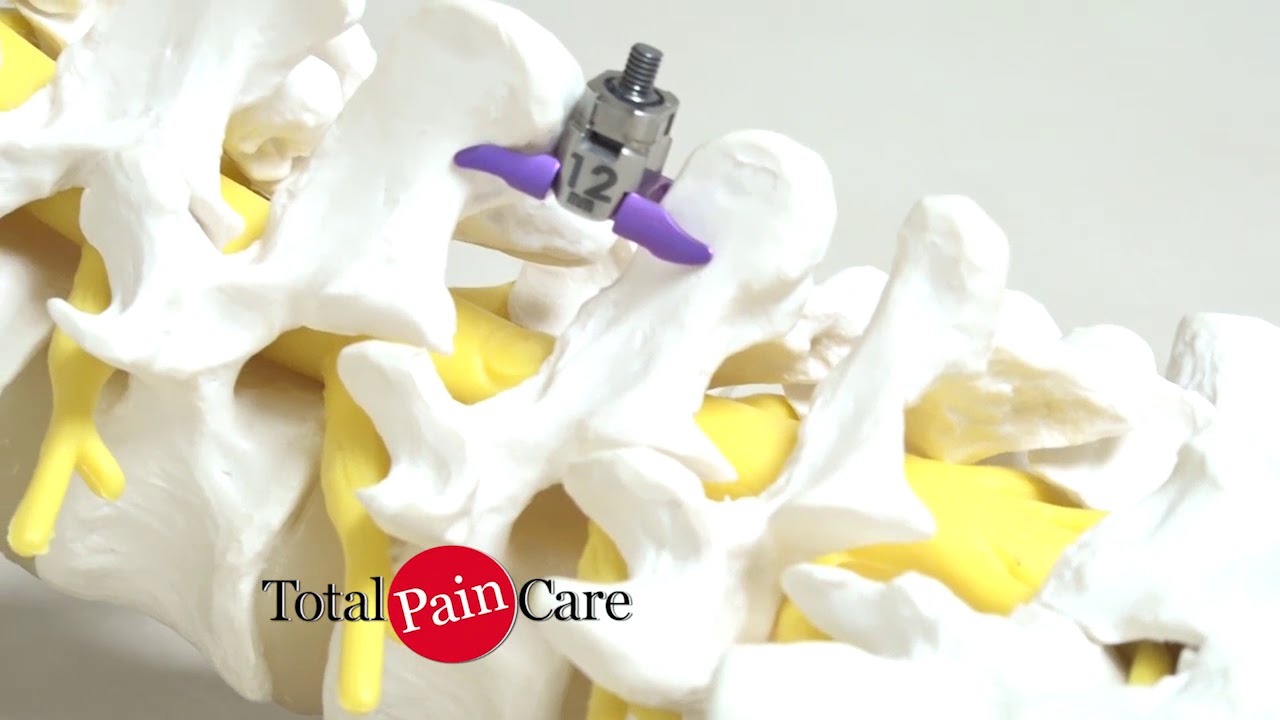 Dr Staggs Spinal Stenosis 2 - YouTube