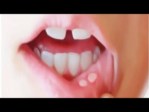 folib plus tablet uses for mouth ulcer - YouTube