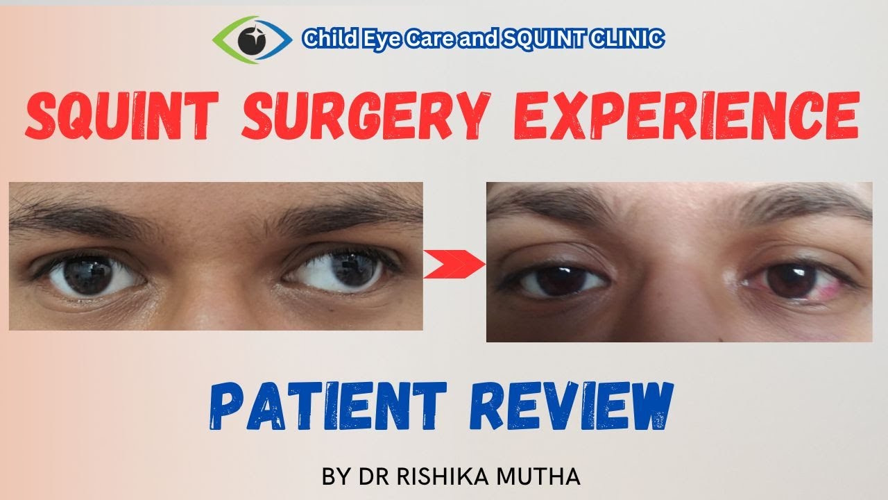 Squint surgery in india | Best squint treatment in india - YouTube