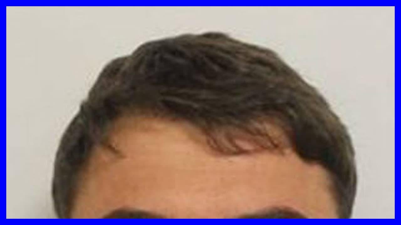 Arthur Collins acid attack victim enters beauty competition after being ...