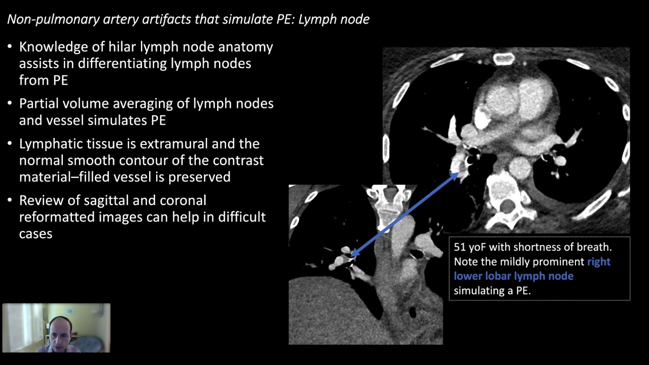 Pitfalls in Interpreting CT Pulmonary Angiograms - YouTube