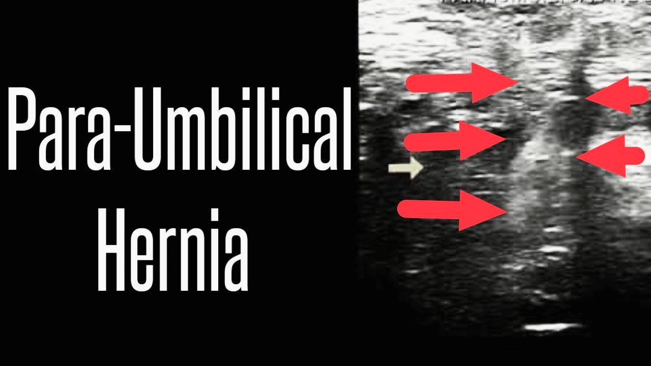 Ultrasound video showing Paraumbilical Hernia - YouTube