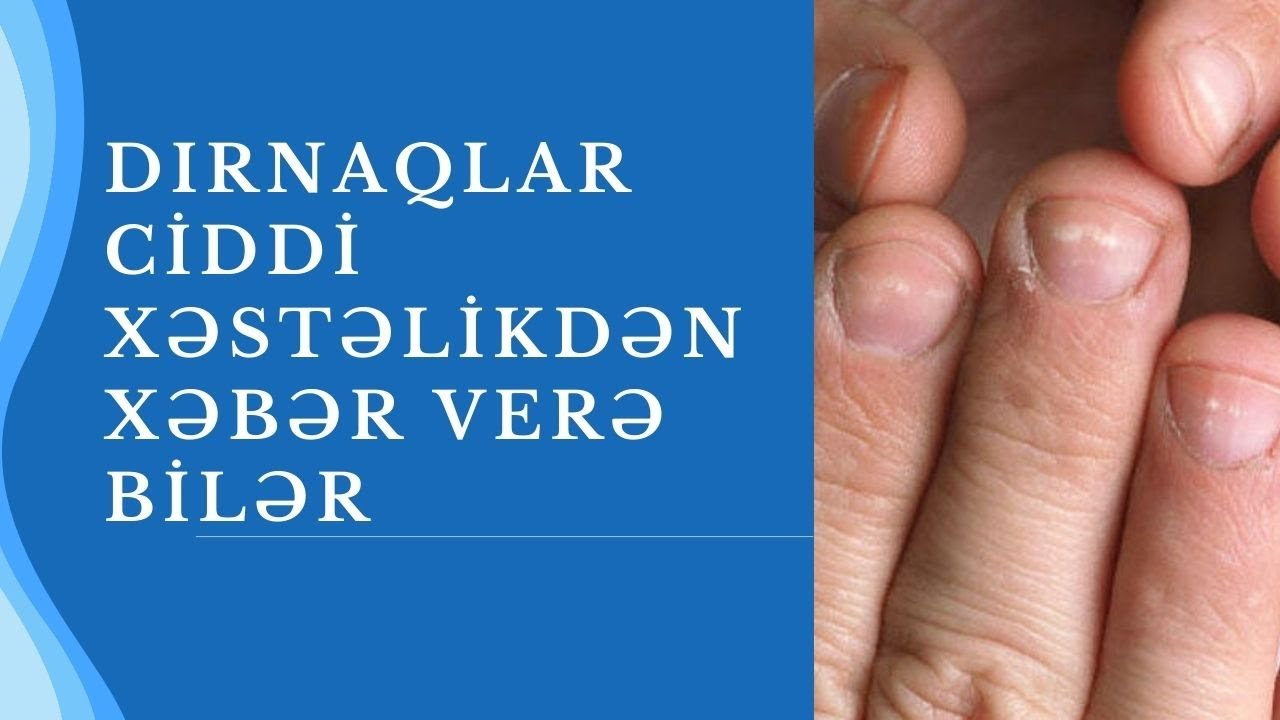 Dırnaqlar ciddi xəstəlikdən xəbər verə bilər - YouTube