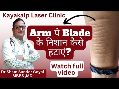 Arm Blade Cut Marks | Cost | Session | Kayakalp Laser Clinic - YouTube