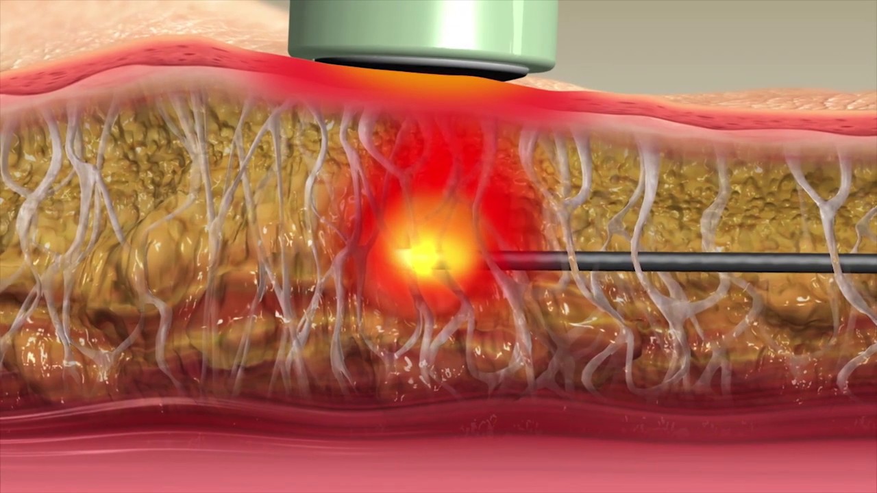 BodyTite and FaceTite by InMode - YouTube