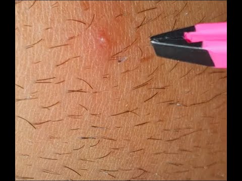 Plucking infected hair - YouTube