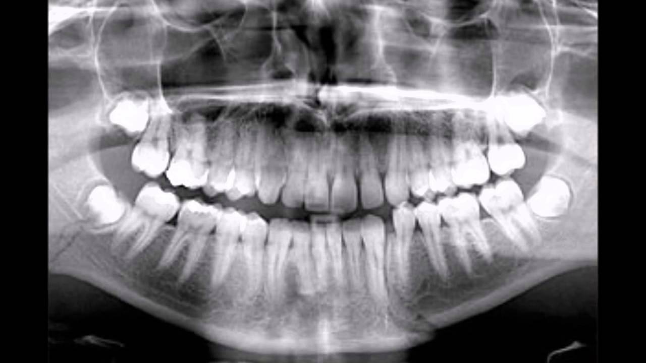 natuurkunde röntgenstraling - YouTube
