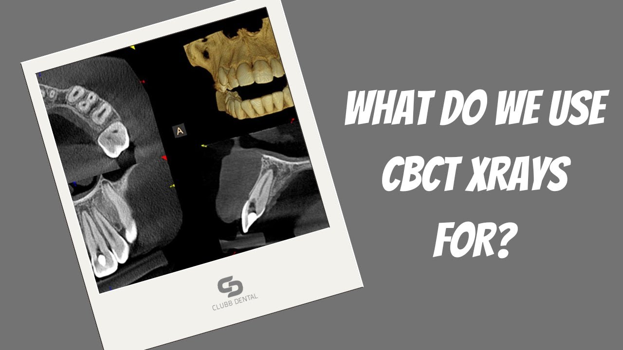 What do we use CBCT Xrays for? - YouTube