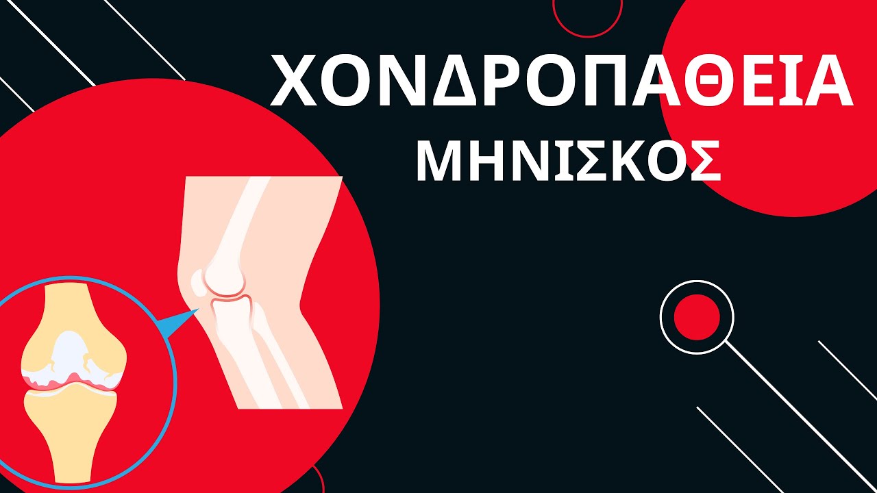 Αυτοθεραπεύεσαι τους πόνους από τον εσω μηνίσκος και Χονδροπάθεια ...
