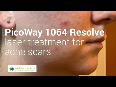 PicoWay 1064 Resolve for Acne scars Treatment #2 - YouTube