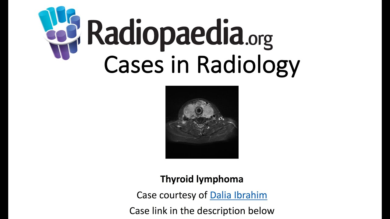 Thyroid lymphoma (Radiopaedia.org) Cases in Radiology - YouTube