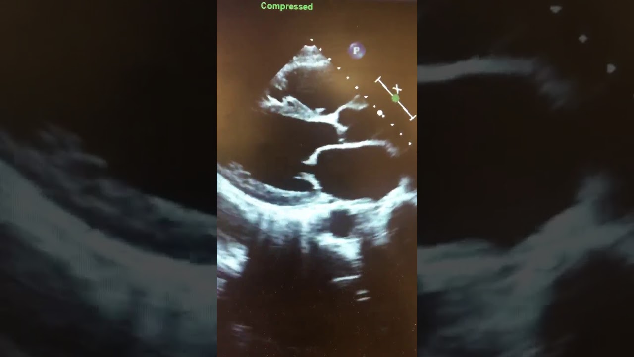 What Is Severe Lv Systolic Dysfunction | SEMA Data Co-op