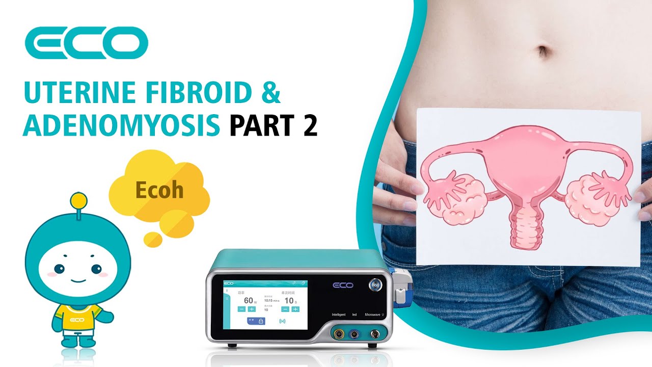 Eco Microwave Uterine Fibroid And Adenomyosis 2 Youtube