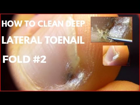 How to clean Deep lateral toenail fold #2 - YouTube