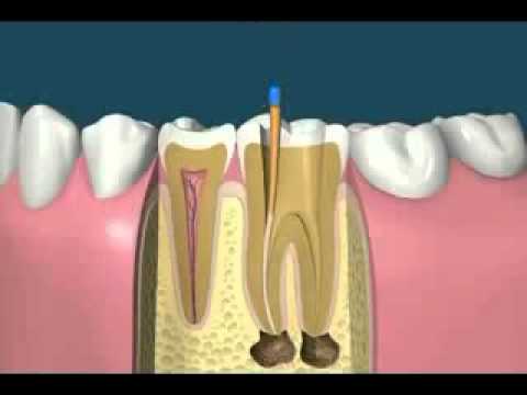 Root Canal Treatment Procedure - YouTube