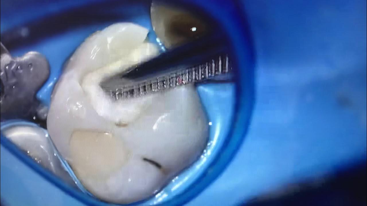 Direct pulp capping - direkt pulpa kuafajı - YouTube