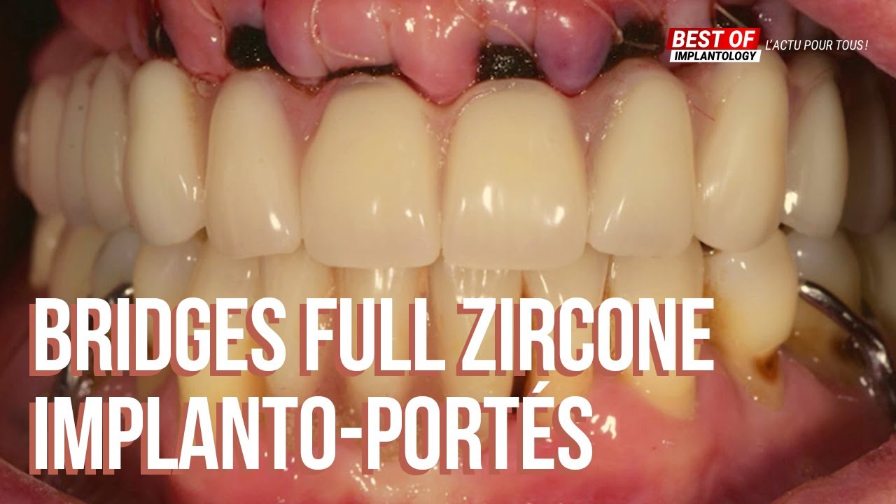 Les bridges full zircone implanto-portés // Implant-supported full ...