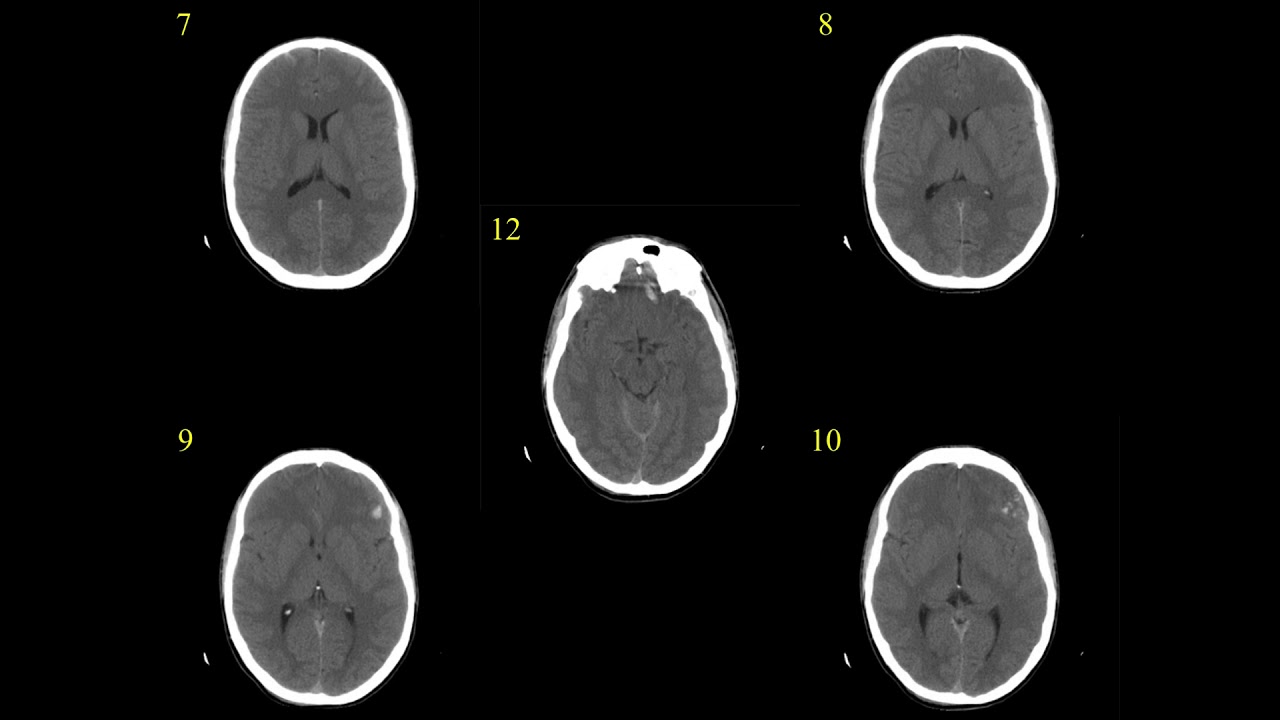 Head CT Scan Interpretation 2018 LBStack - YouTube