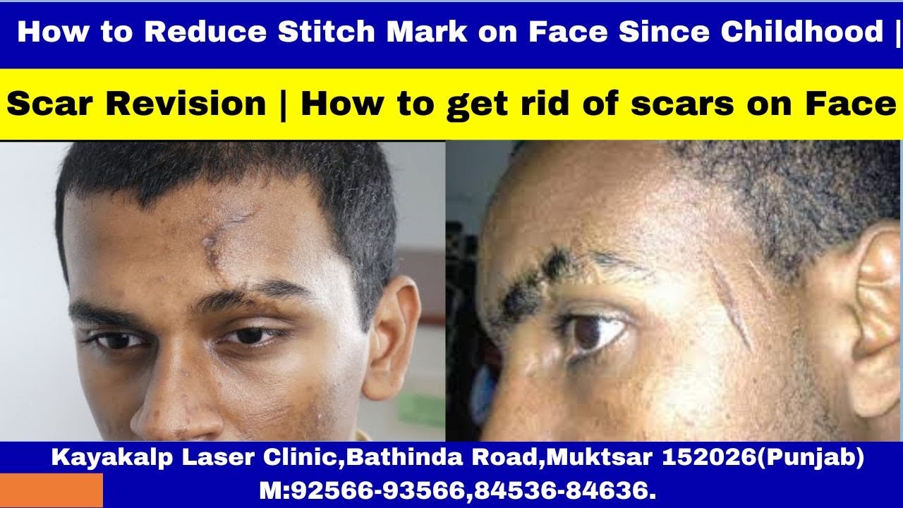 How to Reduce Stitch Mark on Face Since Childhood | Scar Revision | How ...