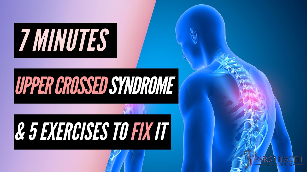Upper Crossed Syndrome and Best Exercises to Fix it - YouTube