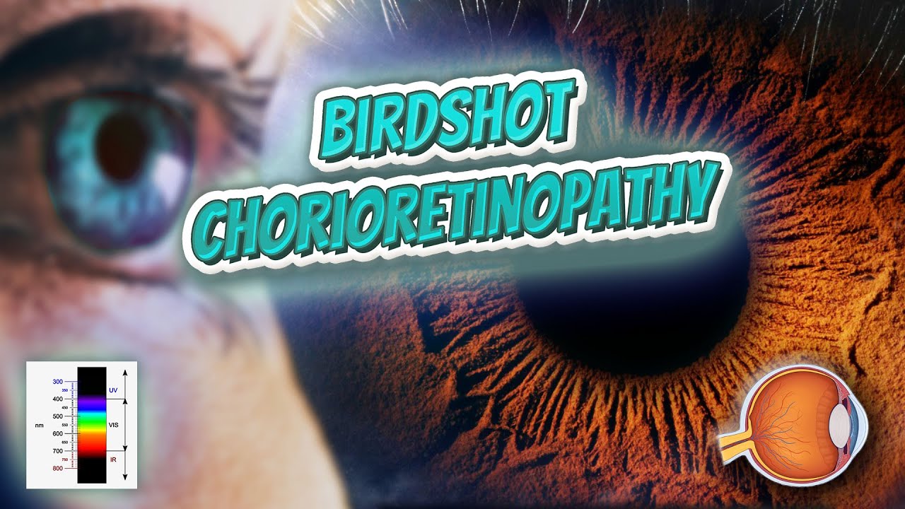 Birdshot chorioretinopathy - Your EYEBALLS - EYNTK 👁️💉😳💊🔊💯 - YouTube