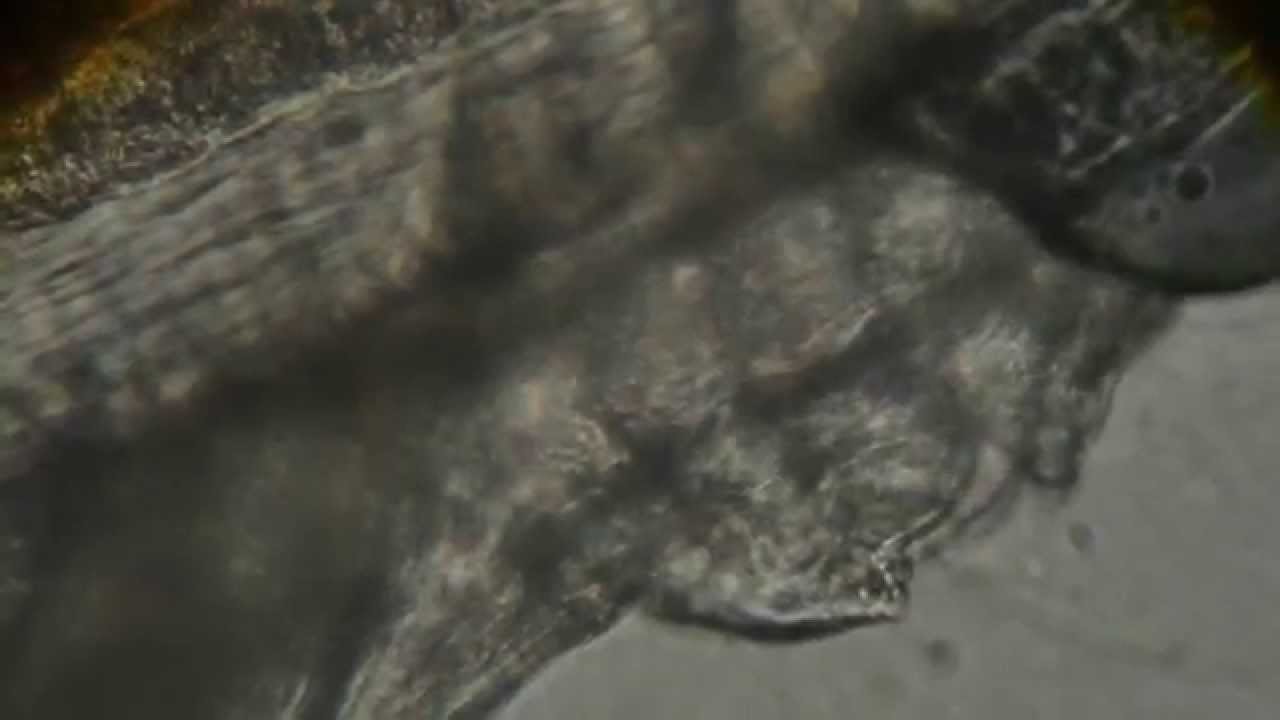 Parasitic infection of human eye lash - YouTube