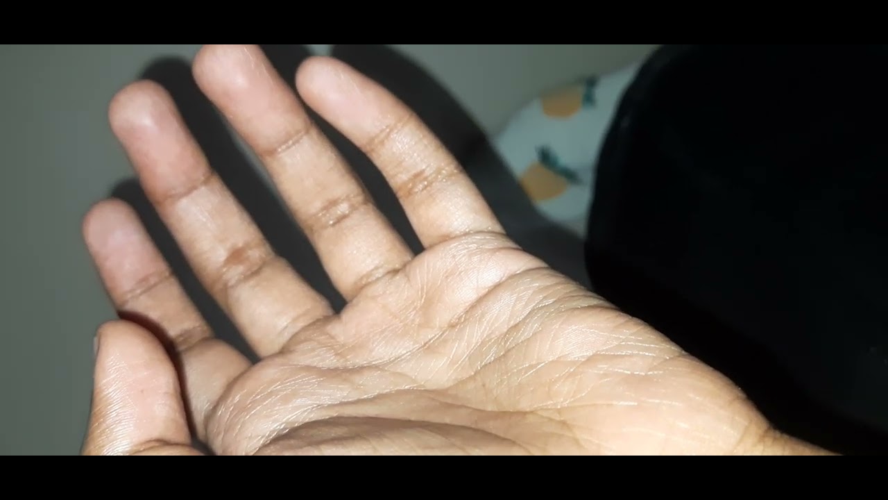 Muscle twitch on pinky finger (muscle spasm) - YouTube