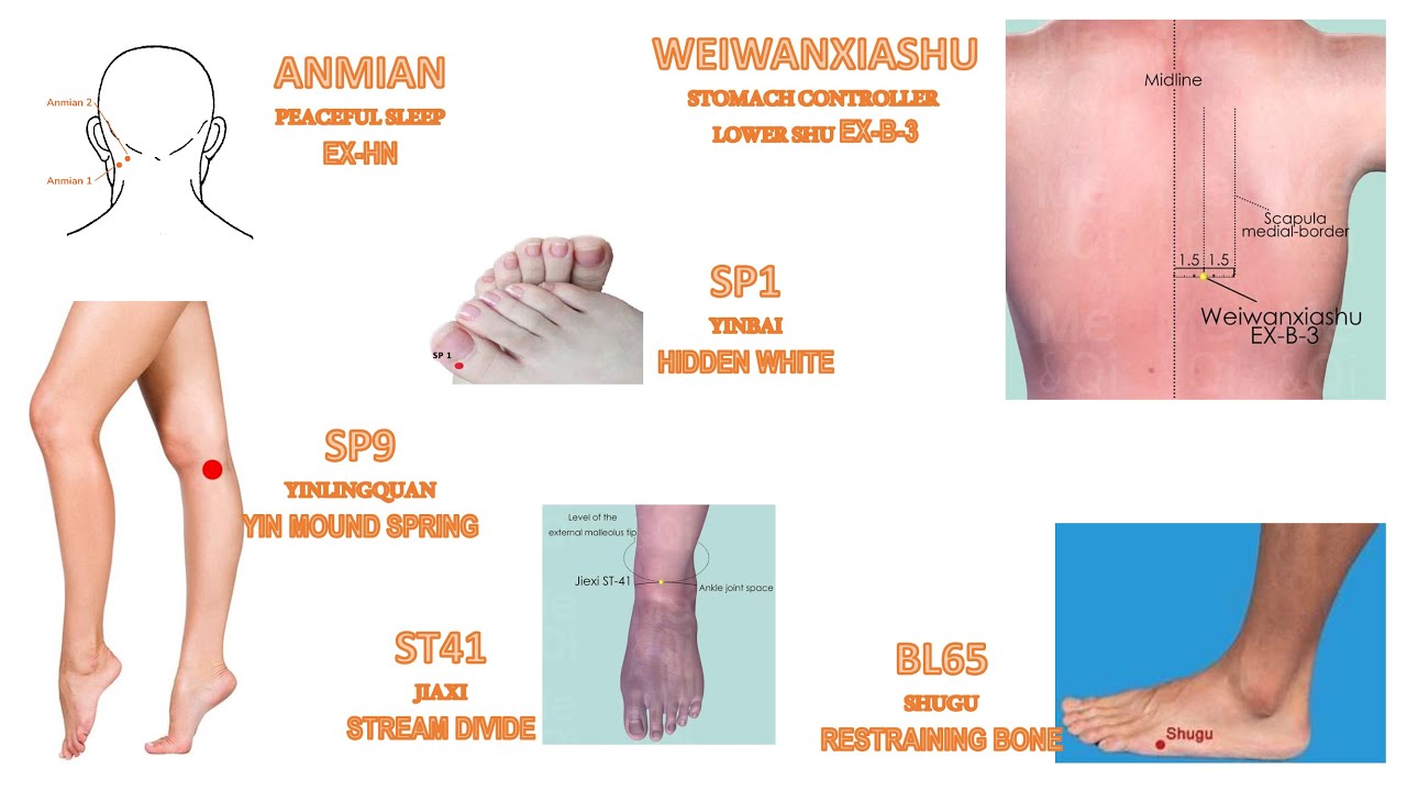 LAMP ACUPUNCTURE 35: SP9, BL65, Anmian, Weiwanxiashu, ST41, Ankle and ...