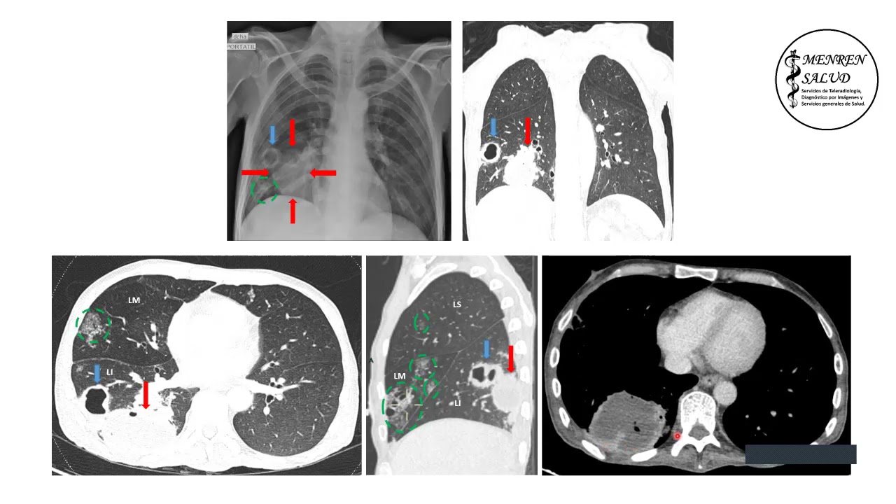 Caso clínico de neumonía necrotizante complicado con absceso pulmonar y ...
