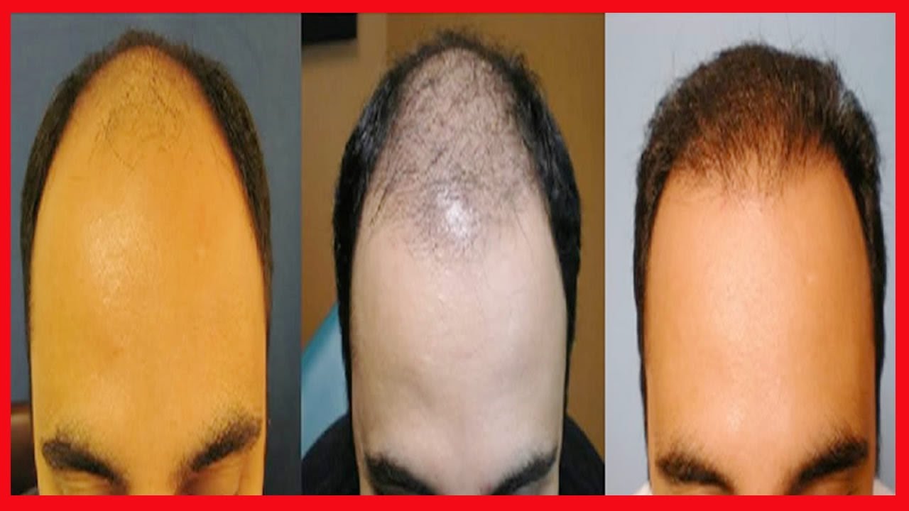 DE CARECA A CABELUDO EM 30 DIAS Como eu Deixei de ser Careca em 30 Dias ...